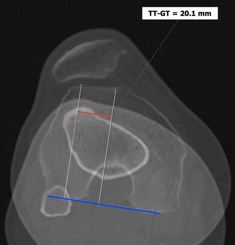 髌骨不稳定的诊断与治疗_股骨滑车发育不良Dejour分型（2023） - 好大夫在线