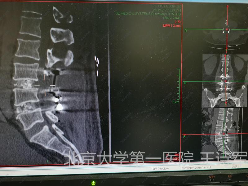 MIDLF手术_腰椎管狭窄 - 好大夫在线