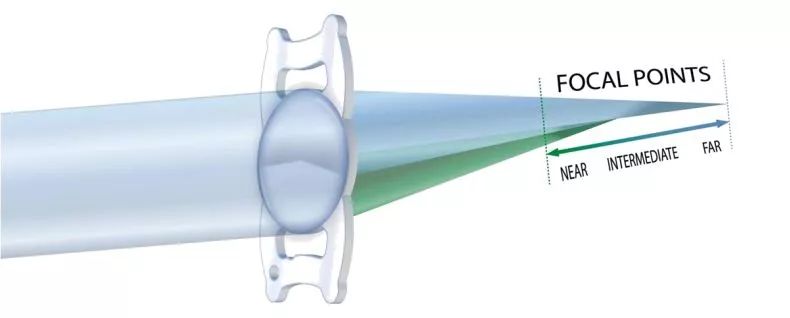 LASIK术后植入SBL-3区域折射IOL的设计要点及效 - 好大夫在线
