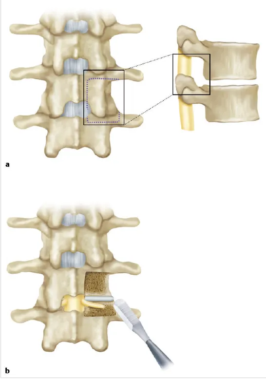 后路腰椎椎体间融合术PLIF及TLIF_脊柱侧弯_脊柱侧弯治疗方式 - 好大夫在线