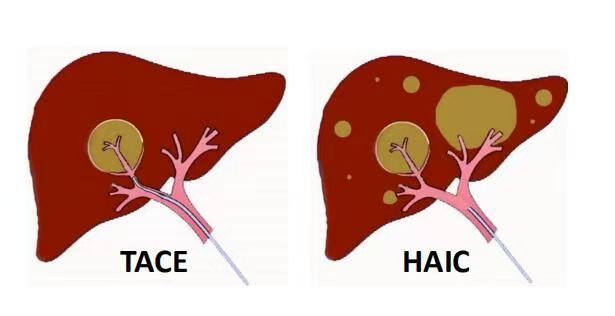 肝动脉灌注化疗（HAIC）在肝脏恶性肿瘤的临床应用_肝癌介入_肝癌介入治疗介绍 - 好大夫在线