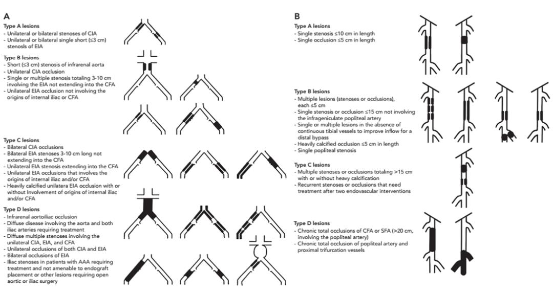 外周动脉不同部位支架置入适应症 与 TASC分类的优先处理方式抉择_动脉硬化闭塞症_动脉硬化闭塞症治疗方式 - 好大夫在线