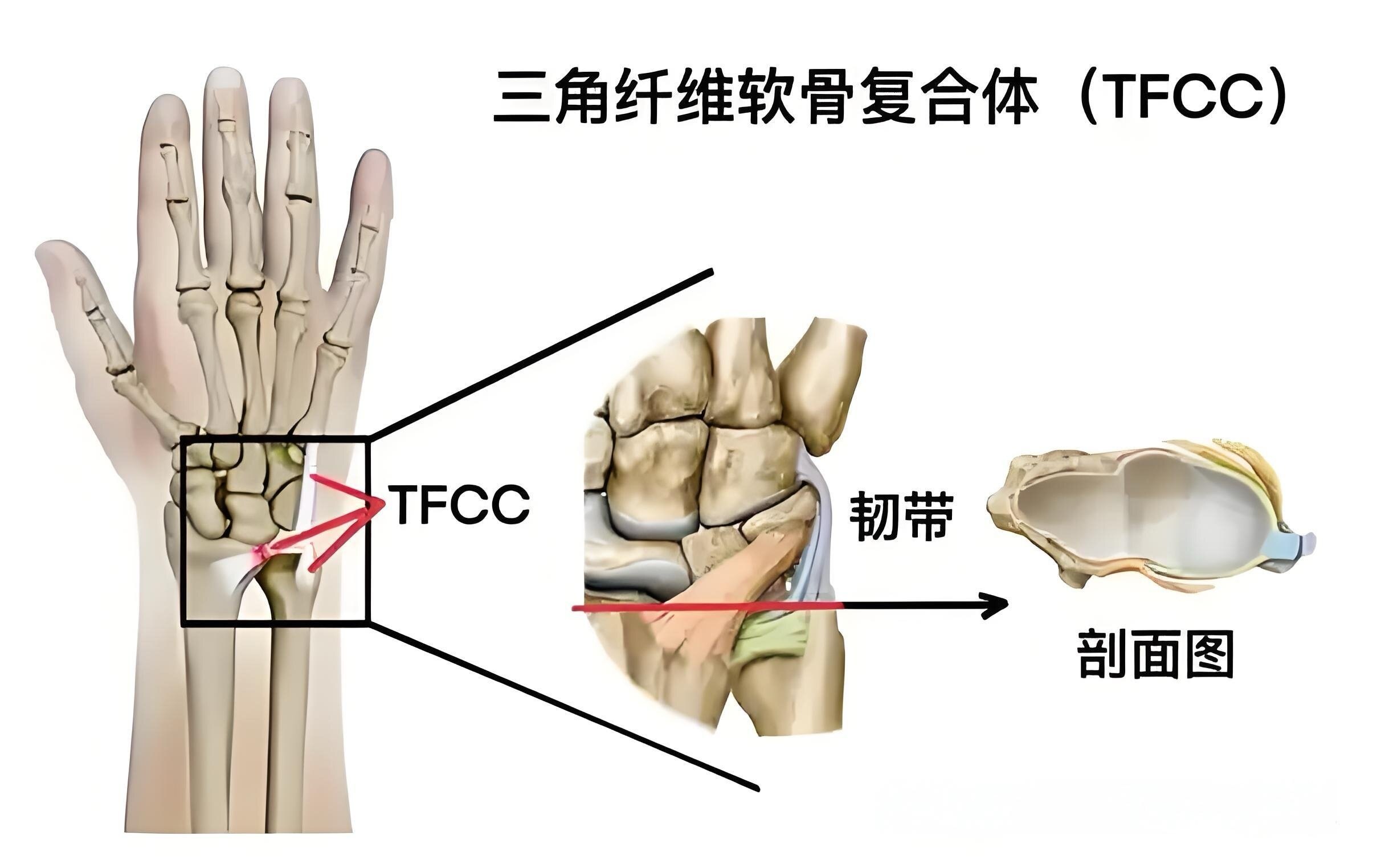 手腕久痛不愈？揭秘TFCC损伤机制与康复路径_腕关节损伤_症状表现_康复锻炼 - 好大夫在线