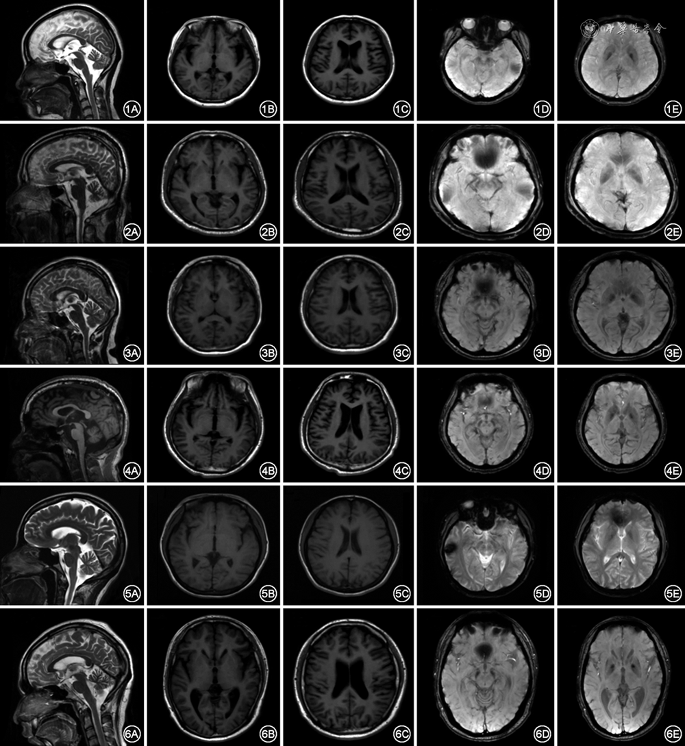 【临床研究】PLA2G6相关帕金森综合征6例临床与遗传学特点并文献复习 - 好大夫在线
