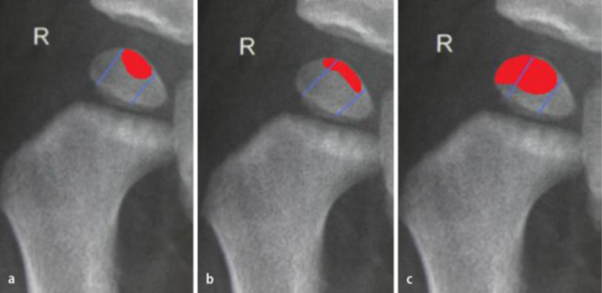 Legg-Calvé-Perthes病（LCPD）：诊断与治疗原则 - 好大夫在线