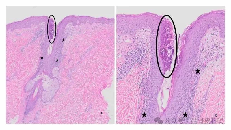 马拉色菌毛囊炎：一种常见真菌性毛囊炎！_毛囊炎_介绍_发病原因_症状表现 - 好大夫在线