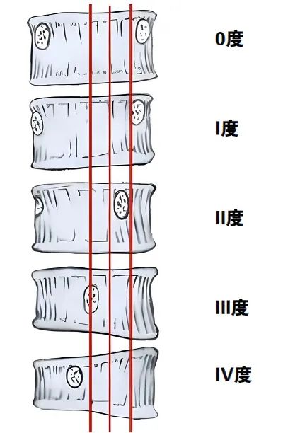 脊柱侧弯的“隐形杀手”：椎体旋转的危害，90%的人都忽略了！_脊柱侧弯_脊柱侧弯介绍 - 好大夫在线